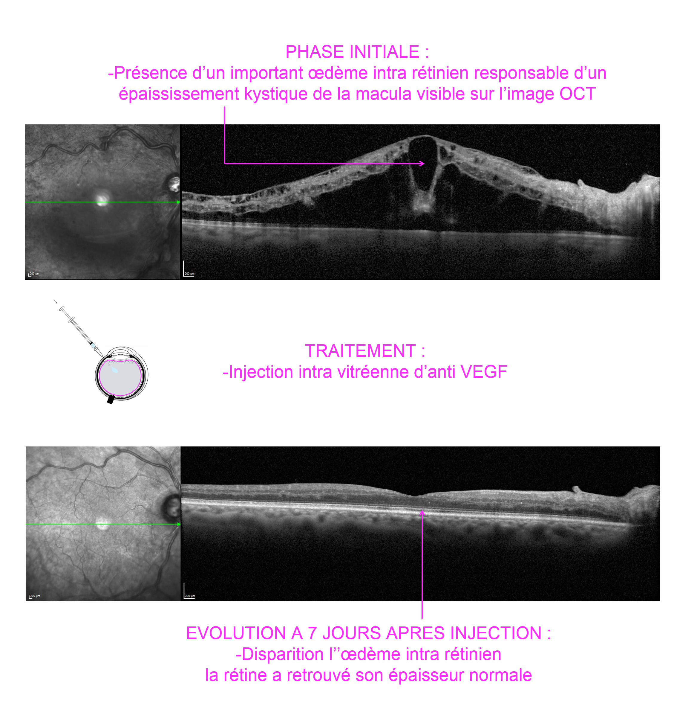 Pathologies oculaires - Les Occlusions de la Veine Centrale de la ...