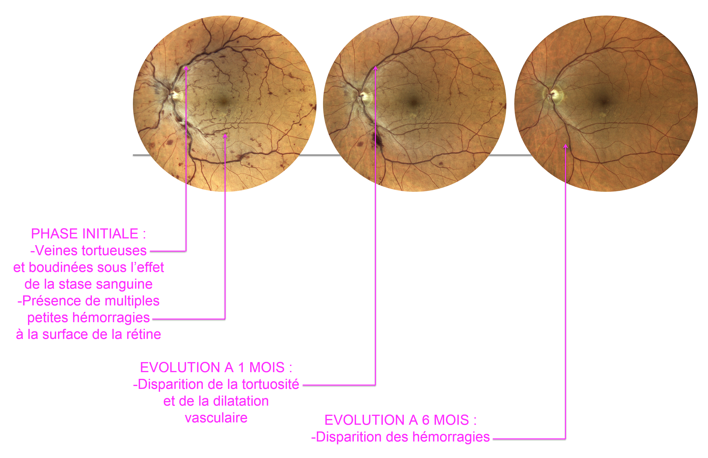 Pathologies oculaires - Les Occlusions de la Veine Centrale de la ...